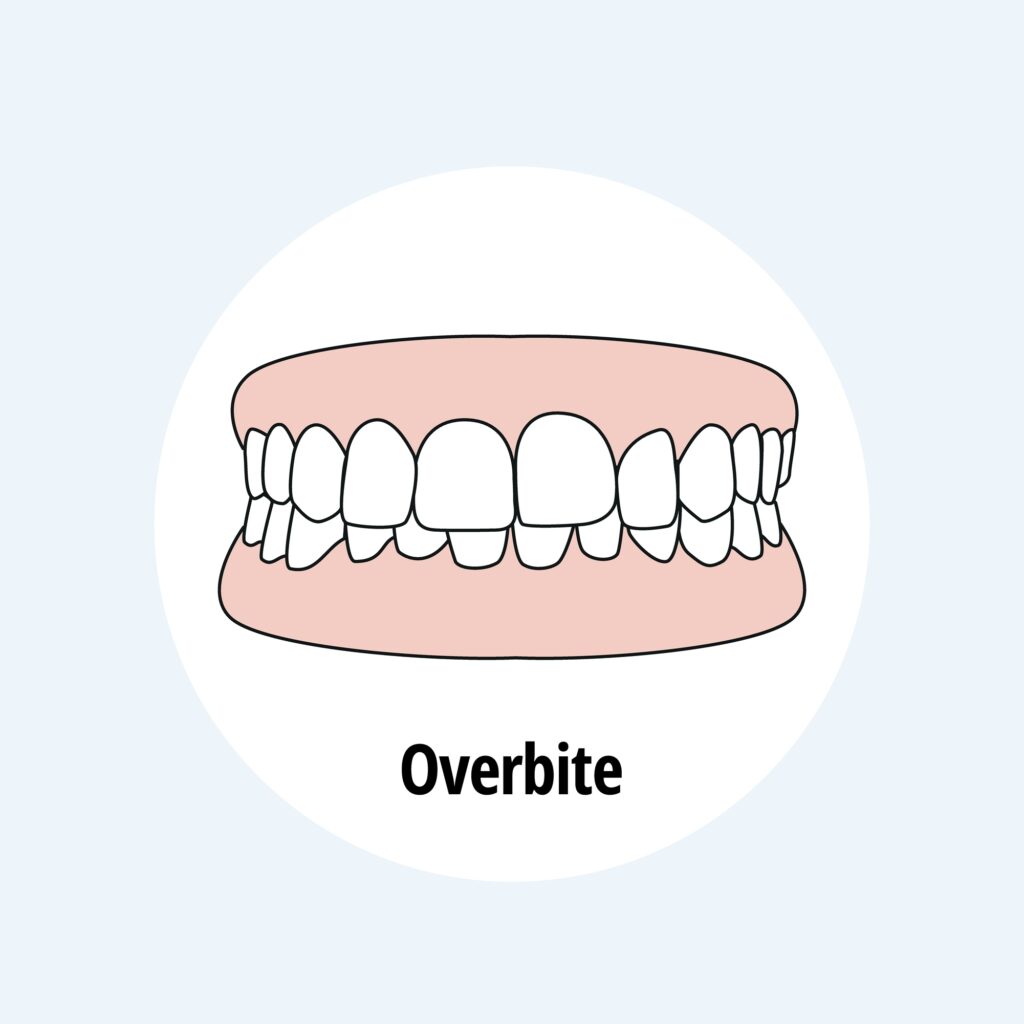 Overjet vs Overbite: What's the Difference and When Is Invisalign Right ...