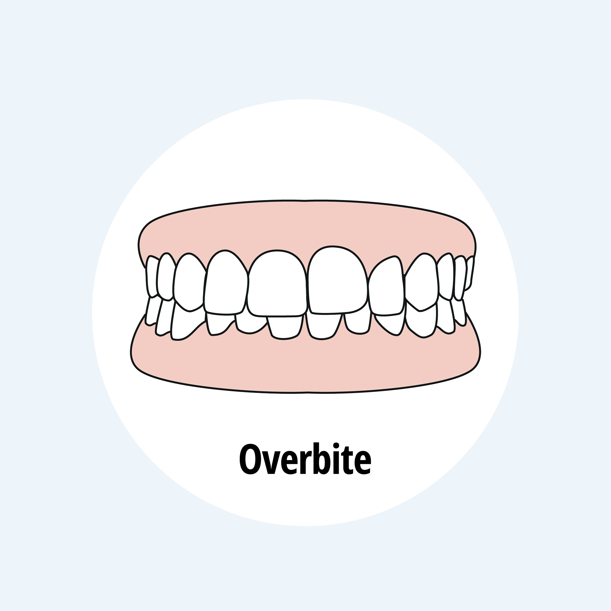 Overjet vs Overbite: What's the Difference and When Is Invisalign Right ...